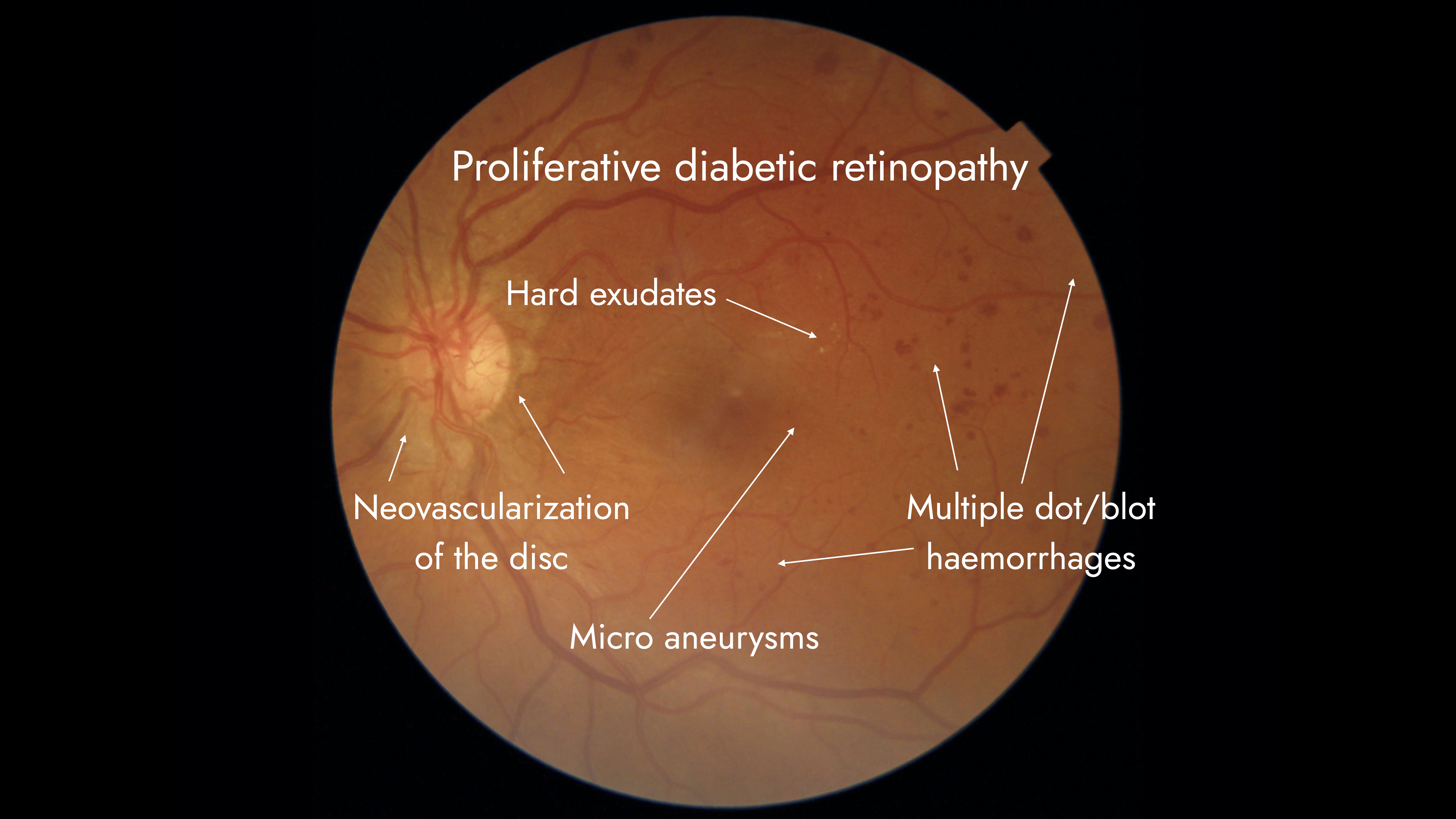 Panretinal Photocoagulation Laser PRP panretinal-photocoagulation-laser-prp